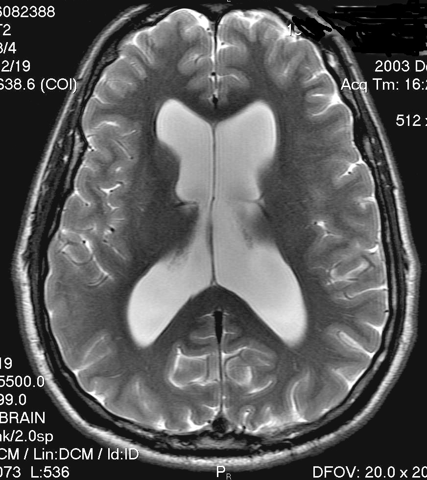 Hydrocephalus Care & Treatment Information with Free Downloadable ...